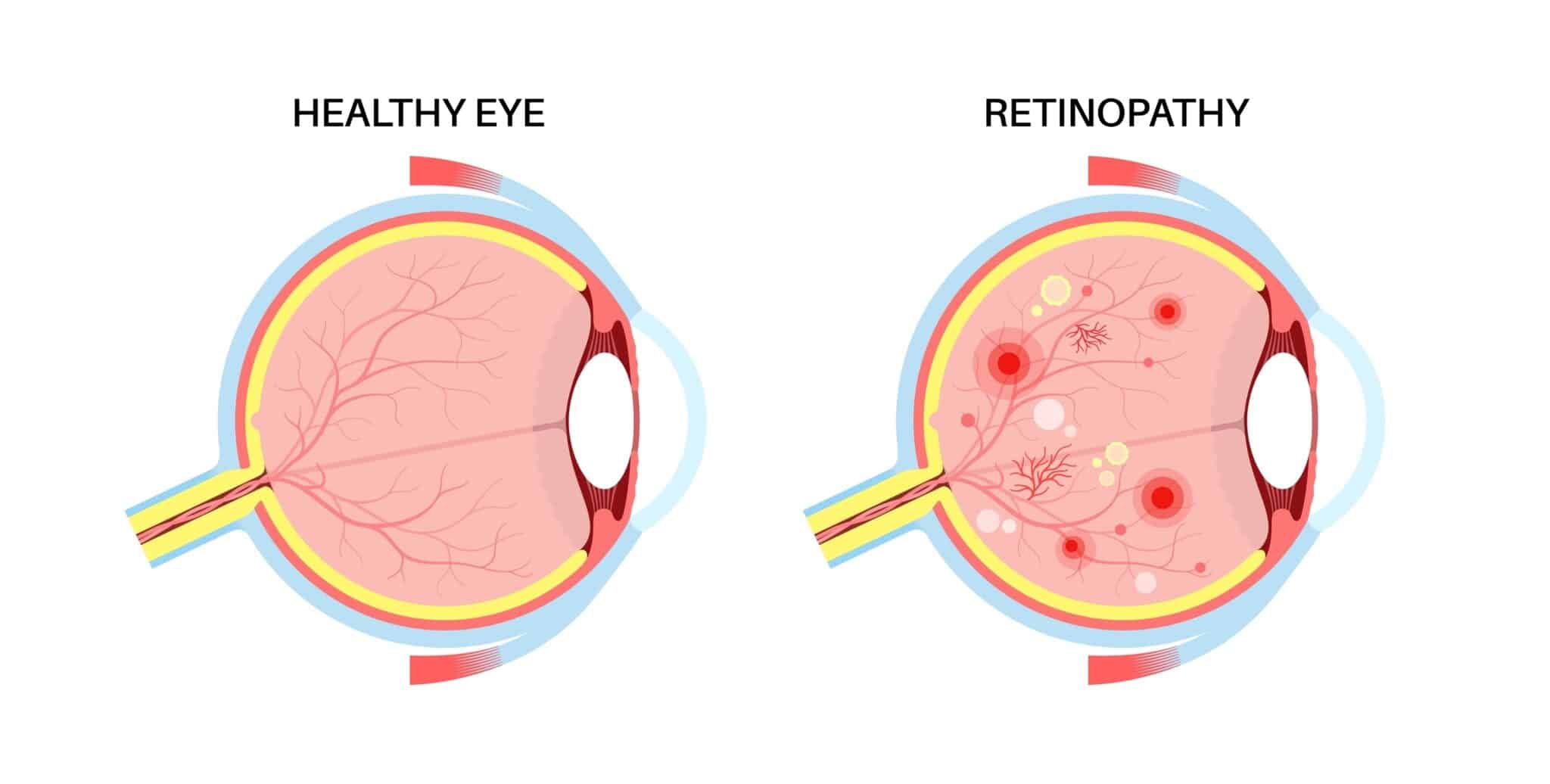 How Diabetes Affects the Retina