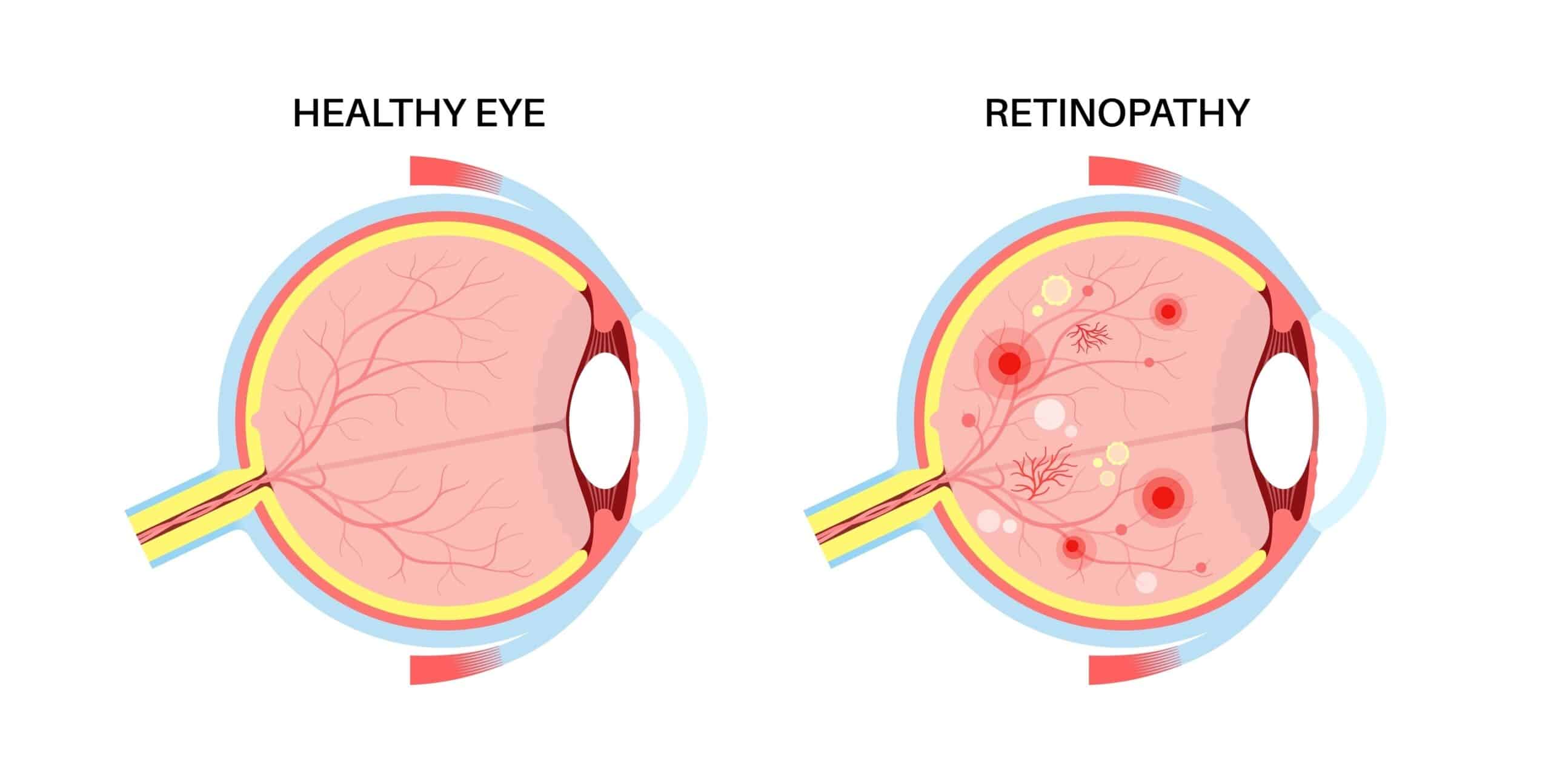 Side by side illustration compares a healthy eye to one with diabetic ...